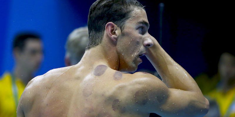 Cupping – Olympic Pseudoscience | Science-Based Medicine