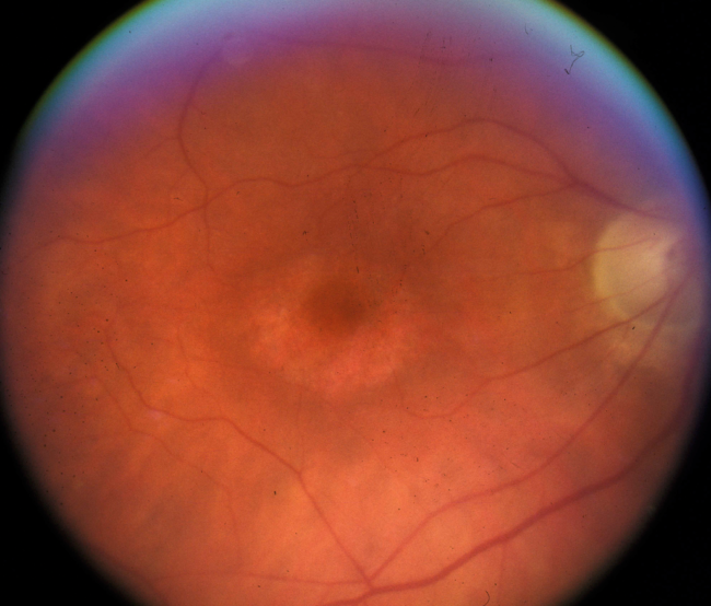 Hydroxychloroquine, retinal toxicity, and COVID-19 | Science-Based Medicine