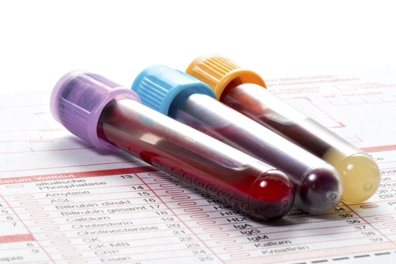 A Blood Test for Fibromyalgia? | Science-Based Medicine